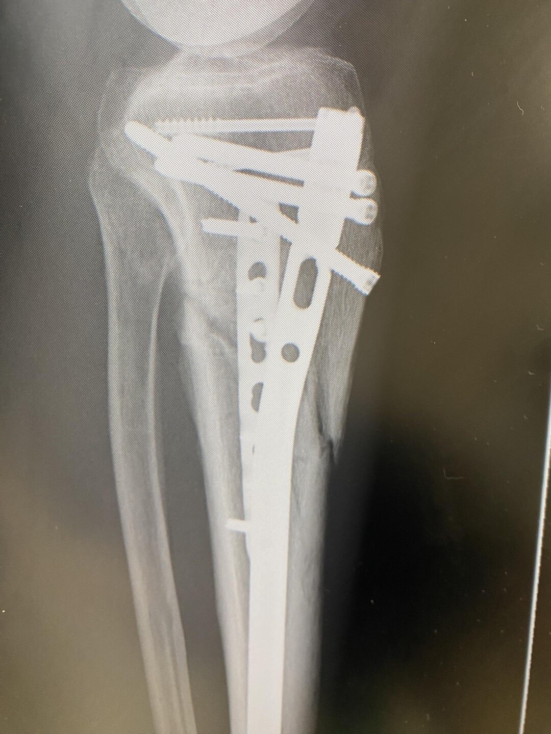 骨折 Third Stage#2 骨折後... / Shin5さんのモーメント | YAMAP / ヤマップ