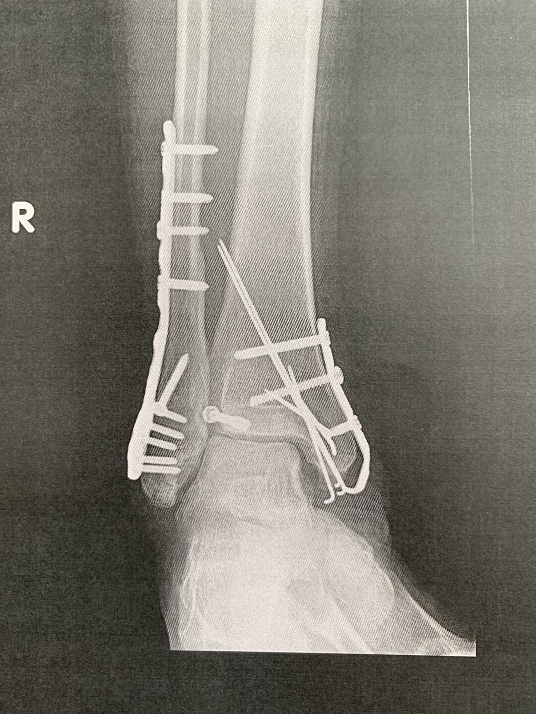 この2枚のプレートの除去手術を受けました... / Viper Zeroさんのモーメント | YAMAP / ヤマップ