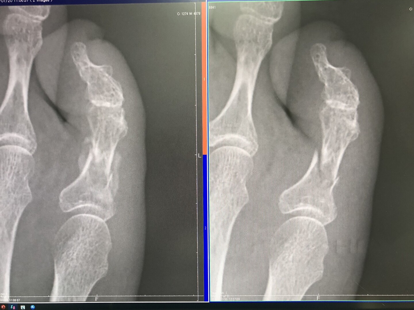 記録です。 6月27日に椅子の脚に右足の... / heeさんのモーメント | YAMAP / ヤマップ