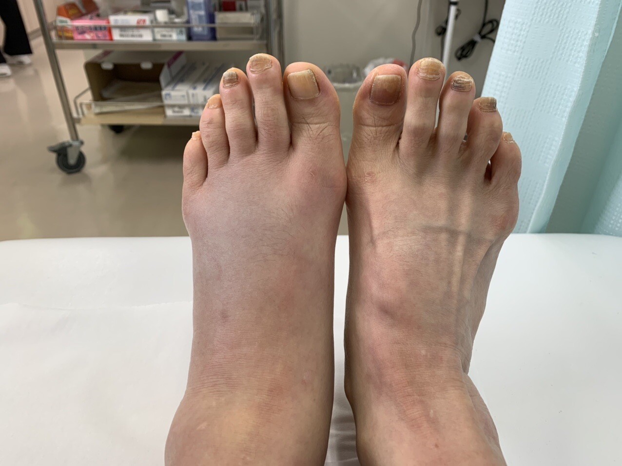 ギプスが外れました‼️ 11/22に米... / jasmineさんのモーメント | YAMAP / ヤマップ