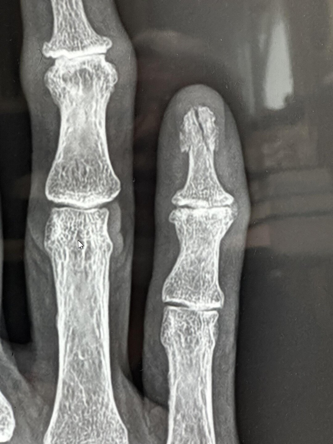 右手小指末節骨縦骨折🦴 2024.6.... / のぶりんさんのモーメント | YAMAP / ヤマップ