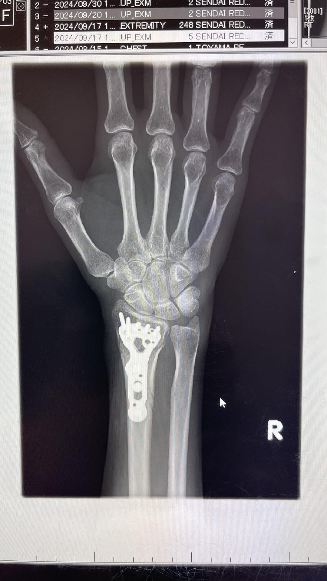 立山で骨折、手術してから約1ヶ月。。。 ... / satorinさんのモーメント | YAMAP / ヤマップ