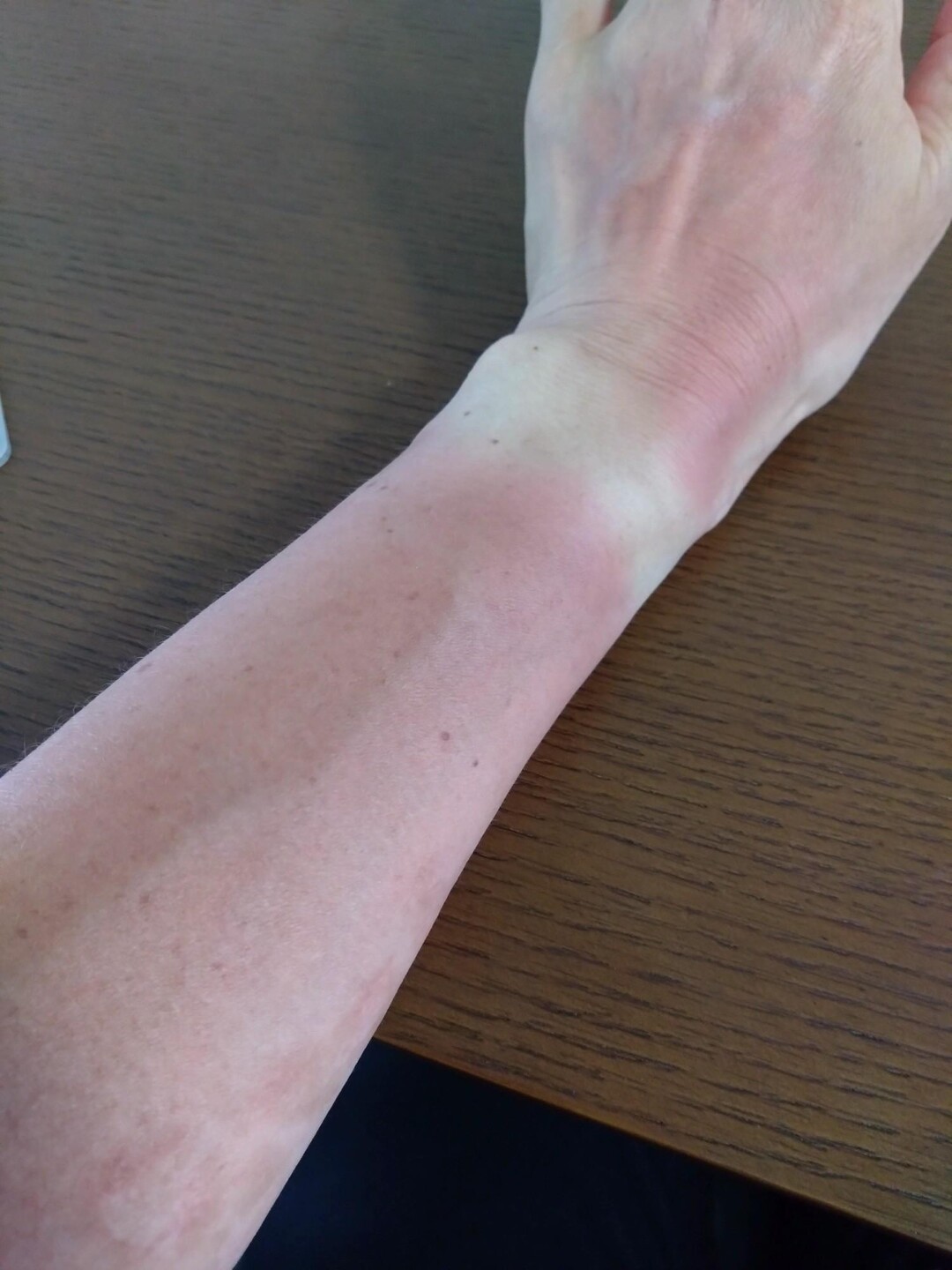 昨日、日焼けしすぎた。 焼きすぎて腕に水... / kmk-nさんのモーメント | YAMAP / ヤマップ