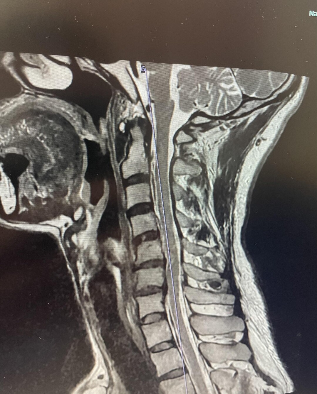 MRIの結果、神経に接触はしてませんでし... / ktさんのモーメント | YAMAP / ヤマップ