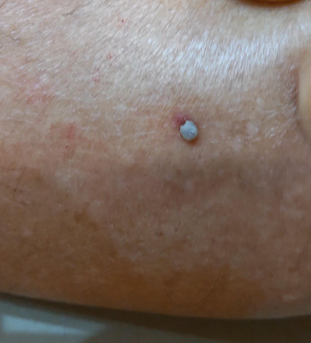 まさかのマダニ体験記 😓 入笠山... / mituo-mさんのモーメント | YAMAP / ヤマップ