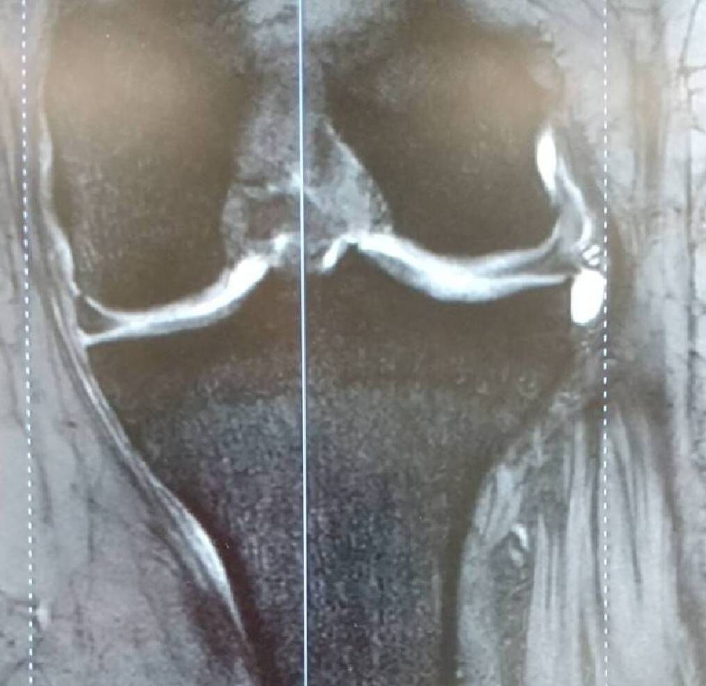 膝MRI結果発表🎉 多少の変形は、ある... / あっこっこさんのモーメント | YAMAP / ヤマップ