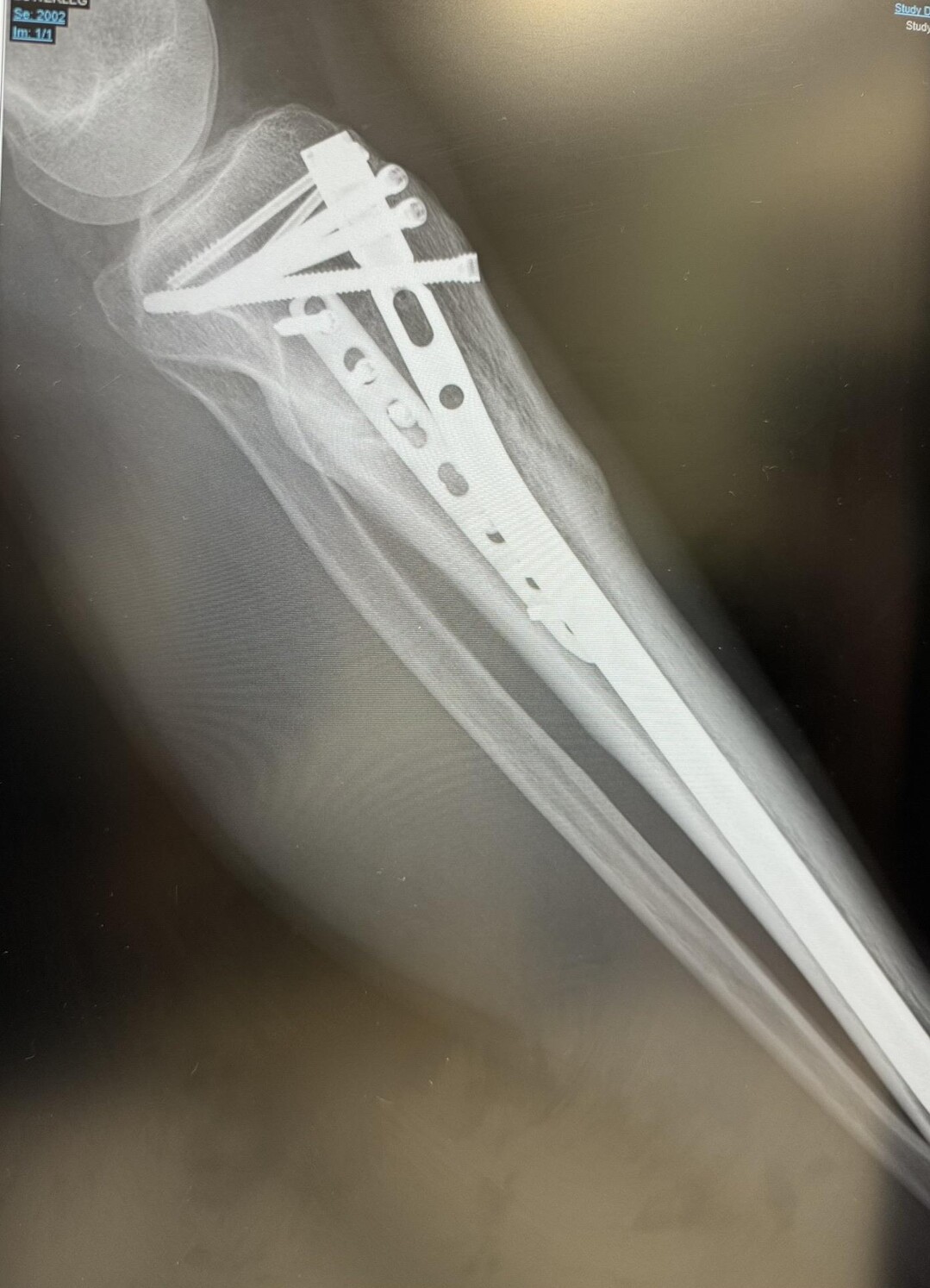 骨折 Third Stage#9 骨折2... / Shin5さんのモーメント | YAMAP / ヤマップ