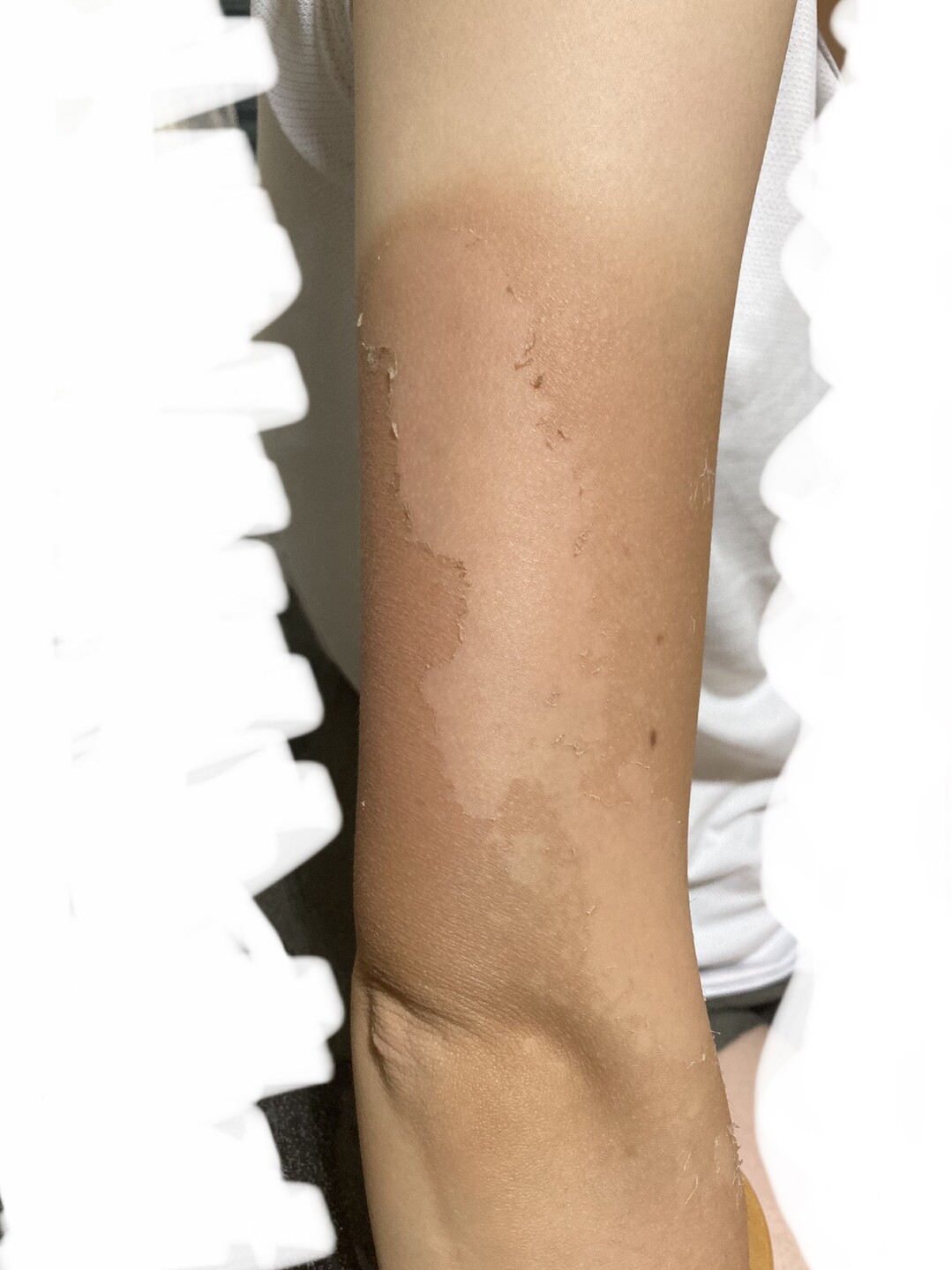 8日目‼️ すがすがしいほど皮むけます... / Rinさんのモーメント | YAMAP / ヤマップ