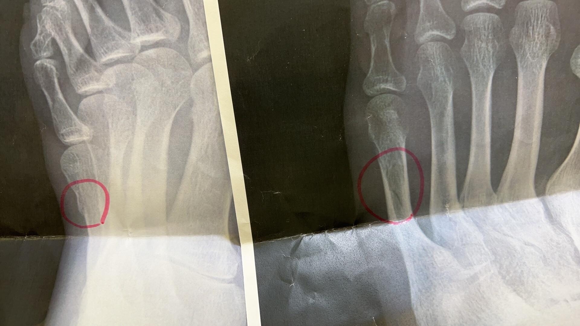 よもやよもやの…骨折してました(￣ ￣;... / いくみさんのモーメント | YAMAP / ヤマップ