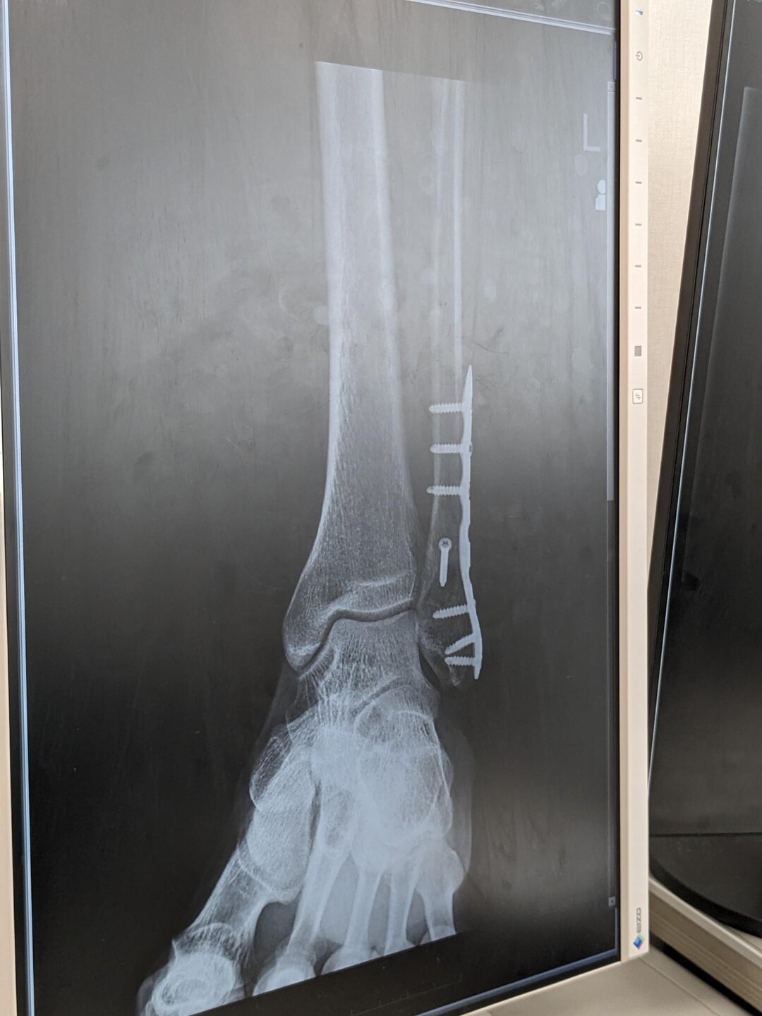 手術後のレントゲン写真。ボルト7本も打ち... / masap🐾🐾さんのモーメント | YAMAP / ヤマップ