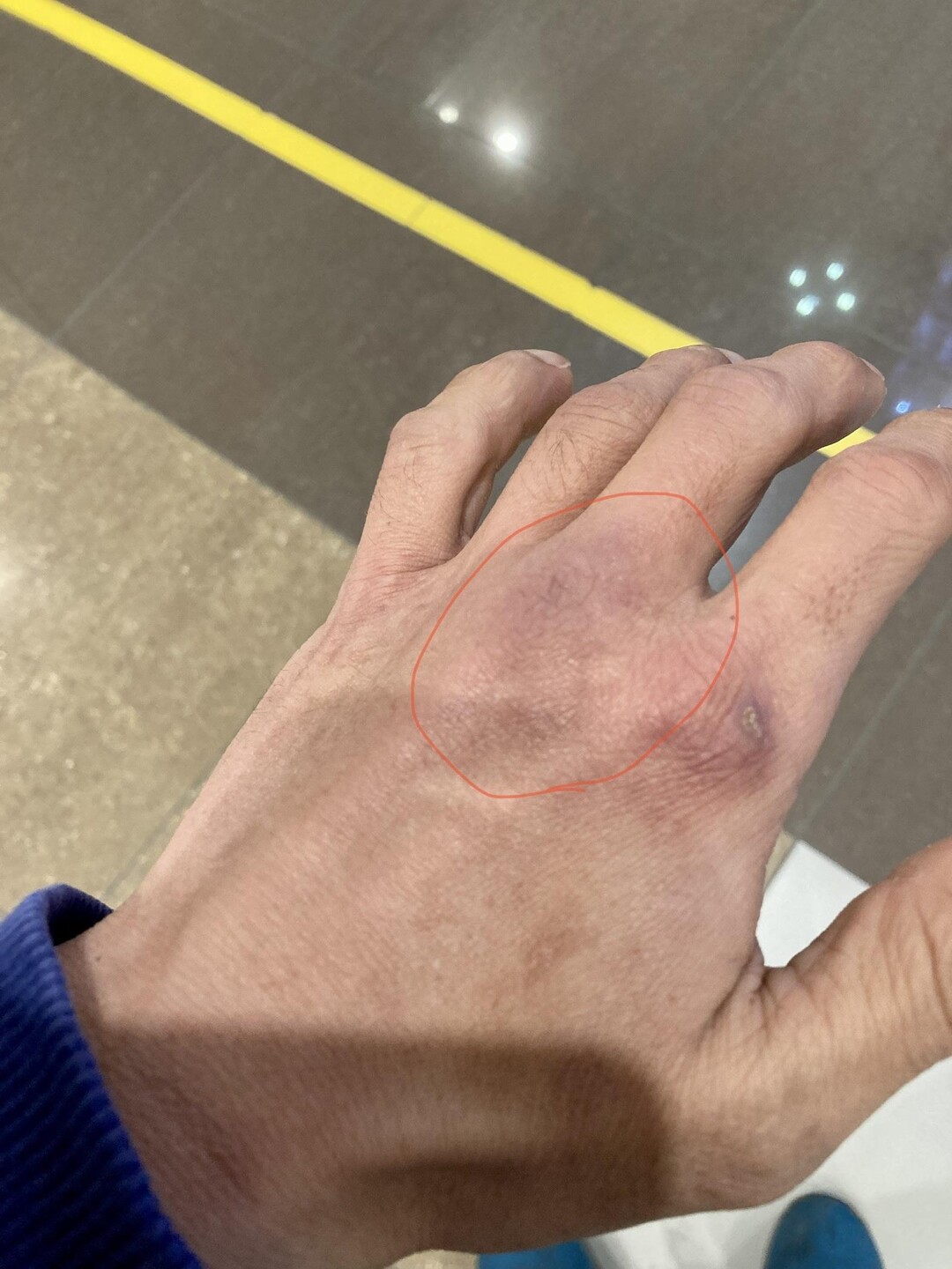 しばらく前から左手中指の付け根辺りが腫れ... / TQさんのモーメント | YAMAP / ヤマップ