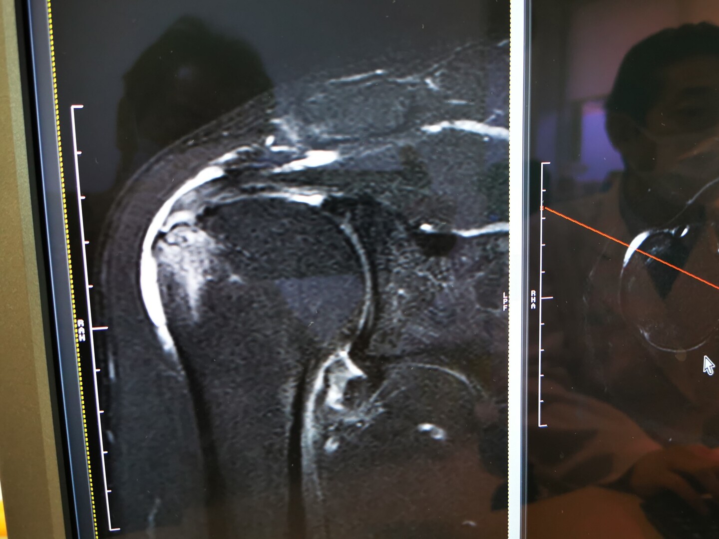 MRIの結果を聴いてきました。腱板は損傷... / はやぶさ半さんのモーメント | YAMAP / ヤマップ