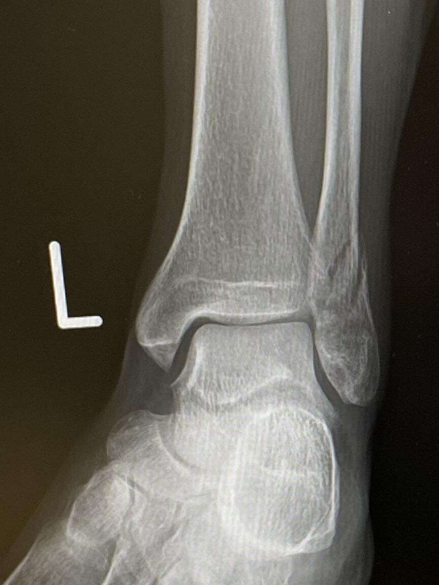 左足首 腓骨にひび入れてから1か月ちょっ... / Water Rabbitさんのモーメント | YAMAP / ヤマップ